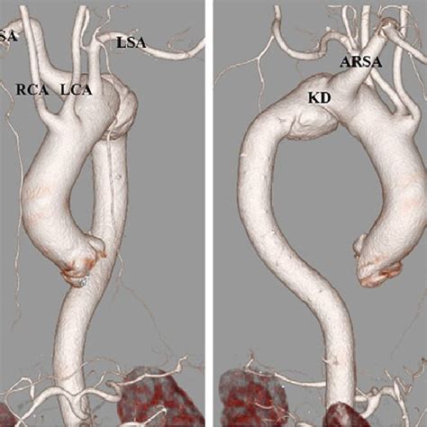 PDF Total Arch Replacement With Bilateral Extra Anatomical Axillary