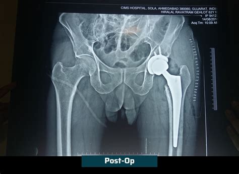 Primary Hip Replacement Surgery Ahmedabad Dr Rachit Sheth