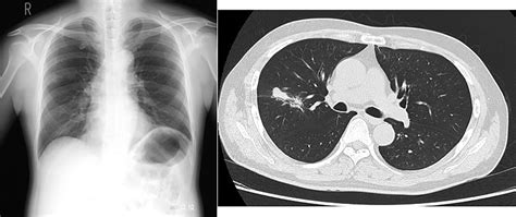Ingenuity Of Minimally Invasive Thoracoscopic Lobectomy For Undiagnosed