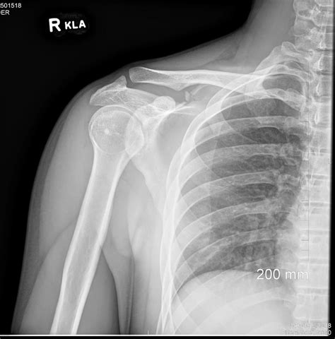 My Broken Scapula R Xrayporn