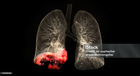 Ct Scan Gambar Rendering Dada Atau Paruparu 3d Menunjukkan Infeksi