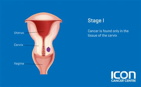 Cervical Cancer Stages