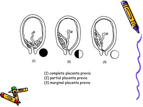 Ppt Placenta Previa Placental Abruption Powerpoint Presentation Free