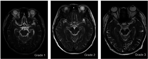 Severity Score Of Dilated Virchow Robin Spaces Dvrs In Hippocampus Download Scientific