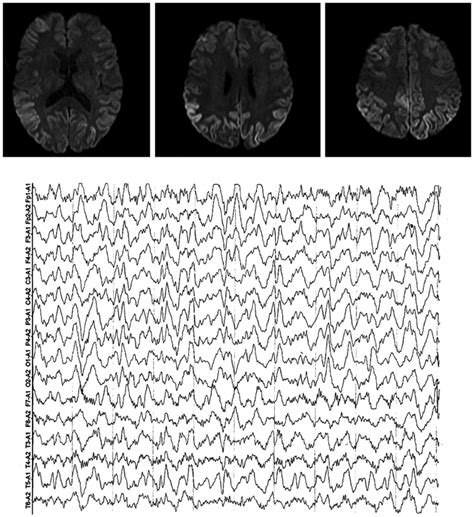 The Cerebriform High Signal In Bilateral Frontotemporal Download Scientific Diagram