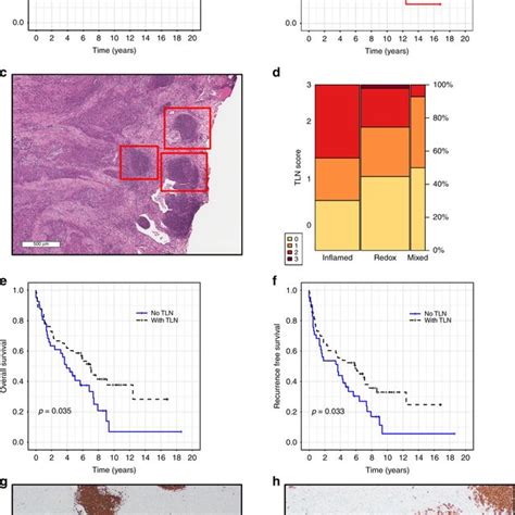 Tertiary Lymph Nodes Tln Are Enriched In The Inflamed Subtype And Are Download Scientific