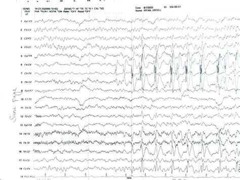 Abnormal Eeg Patterns Pptx Brain And Nervous System Disorders