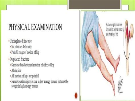 Nof Fracture