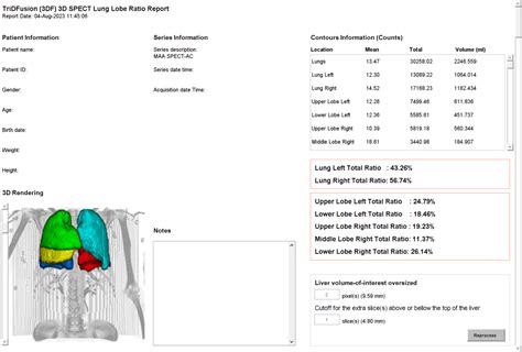 D Spect Lung Lobe Quantification Daniel Lafontaine