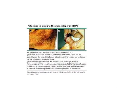 Approach To Thrombocytopenia Pptx