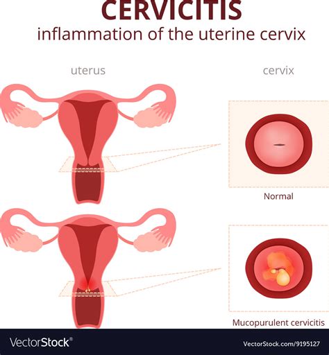 Cervicitis Schematic Royalty Free Vector Image