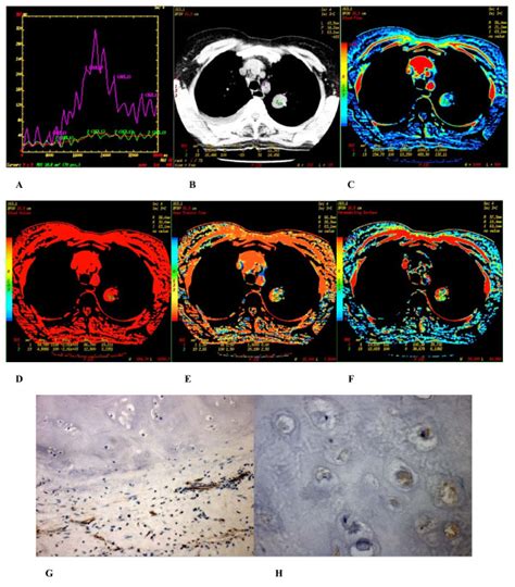A H Hamartoma Found In Apicoposterior Segment Of Superior Of The Left