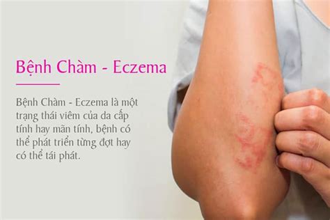 Bệnh Chàm Eczema Có Nguy Hiểm Không Nhận Biết Và Cách điều Trị