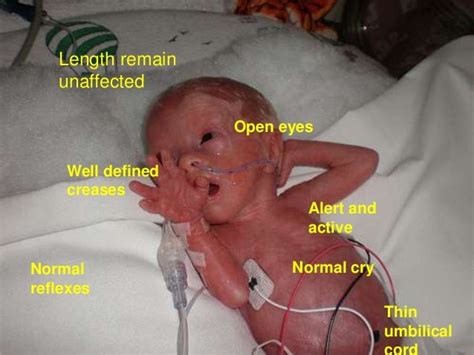 Intra Uterine Growth Retardation