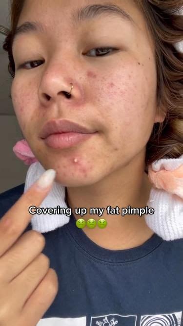 How To Cover While Pop Your Pimples Within A Day Skin Care Routine