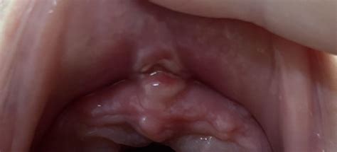 Please Help Denture Ulcer On Labial Frenulum 😭😭😭 Rdentures