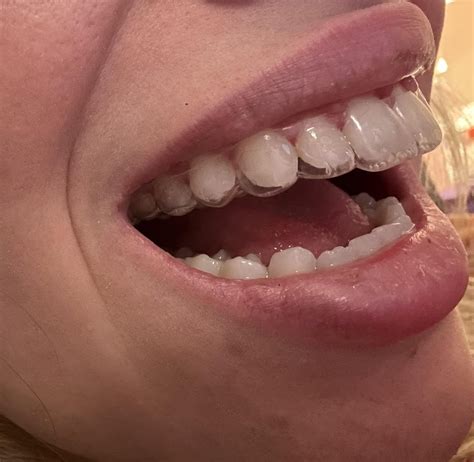 New Set Of Aligners Someone Help Lol R Aligners