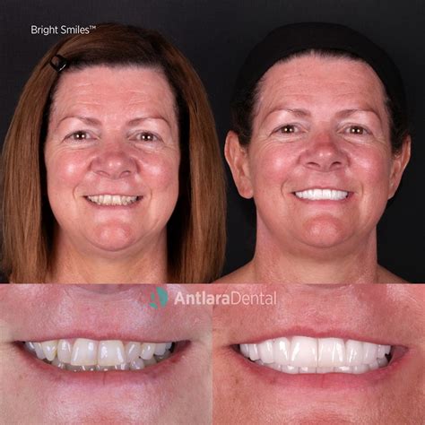 How To Choose The Best Tooth Shade Antlara Timeless White