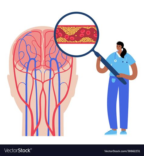 Brain Stroke Ishemic Royalty Free Vector Image