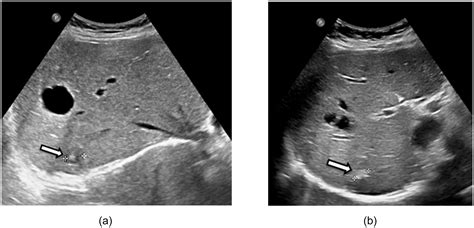 Solitary Necrotic Nodule Of The Liver Imaging Features Differential Diagnosis And Management