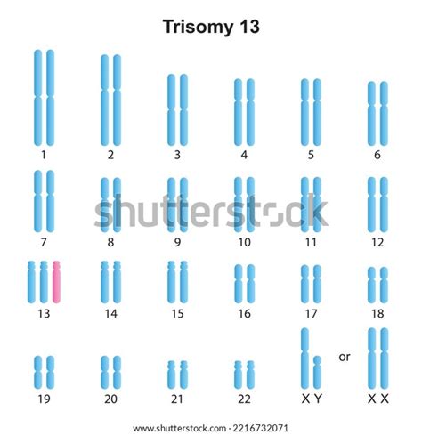 Scientific Designing Patau Syndrome Trisomy Stock Vector Royalty Free Shutterstock