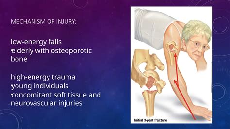 Fracture Of Proximal Humerus Etiopathogenesis Clinical Features And Management Pptx