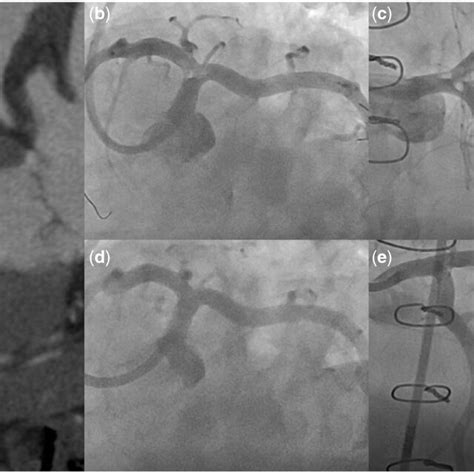 Postoperative Contrast Enhanced Computed Tomography A And Coronary