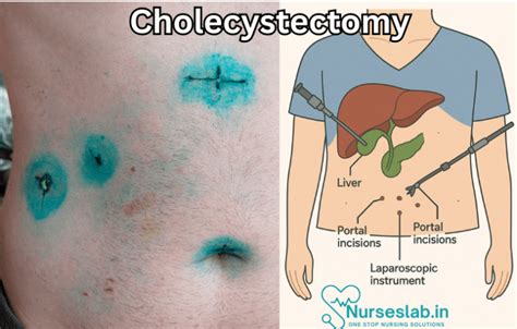 Cholecystectomy Gallbladder Removal Surgery Nurseslab