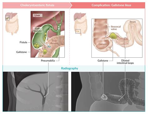 Enterocutaneous Fistula Diagram Enterocutaneous Fistula Stock Image