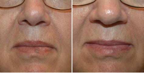 Before And After Of Vascular Malformation On The Lower Lip Treated With