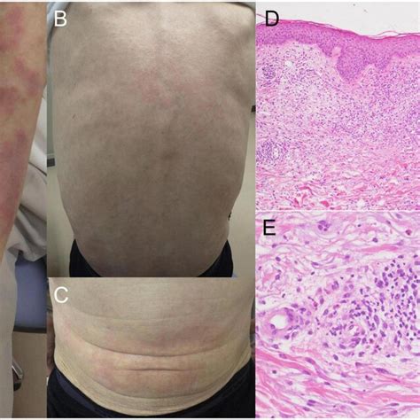 Clinical Manifestations And Histopathology A Multiple Erythematous