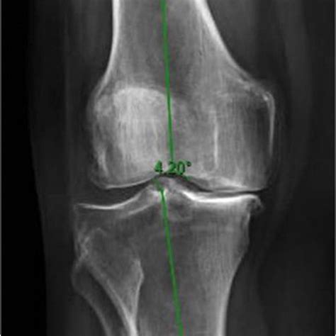 Preoperative Femorotibial Mechanical Axis On Short Radiography Download Scientific Diagram