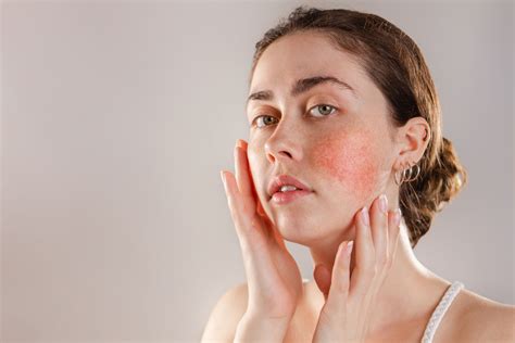 Dermatite atopica cos è e come si tratta Kouriles