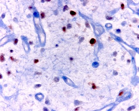 Pathology Outlines Myxoid Liposarcoma