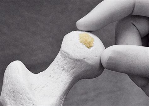 Nanofuse Bioactive Matrix Orb Medical