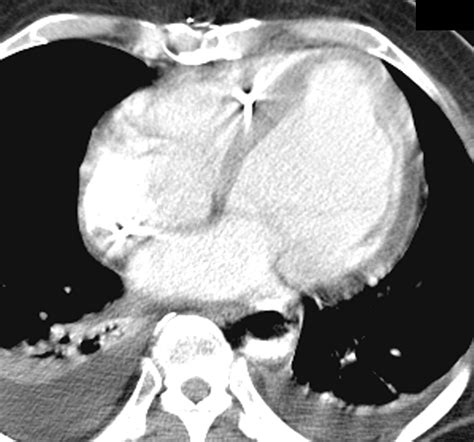 Ct Detection Of Acute Myocardial Infarction Ajr