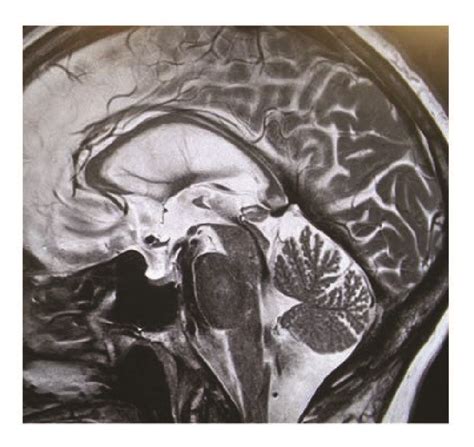One Year Follow Up Brain Mri Sagittal T2 Section A Strong Flow Void Download Scientific