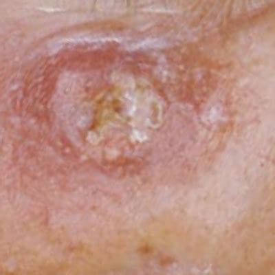 Squamous Cell Carcinoma On Leg