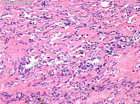 Post Radiation Angiosarcoma
