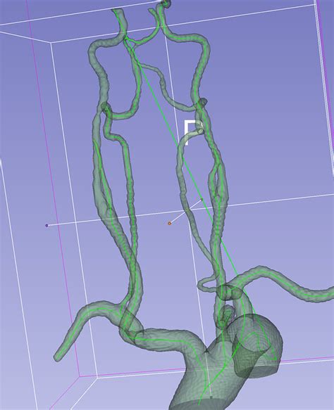 how to obtain the complete center lines using vmtk vmtk 3d slicer