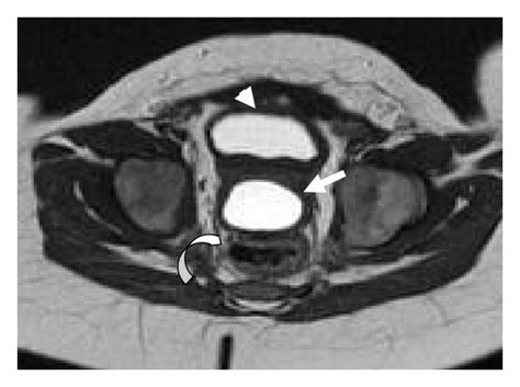 Sagittal A And Axial B T2 Turbo Spin Echo Tse Mr Image Show A T2