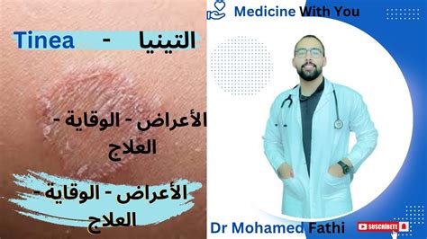 التينيا الحلقية Tinea الأعراض الوقاية العلاج Youtube