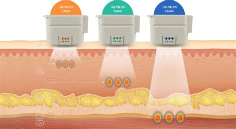 마인성형외과 울쎄라 리프팅 최신 노화 방지 및 리프팅 기술