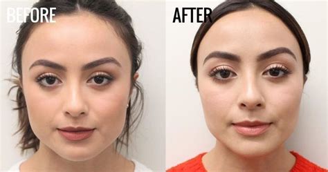 Post Masseter Botox Care Kimberely Matlock