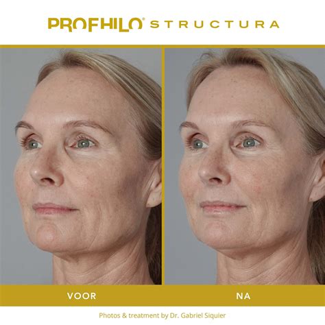 Profhilo Structura Skinsurgery Clinics