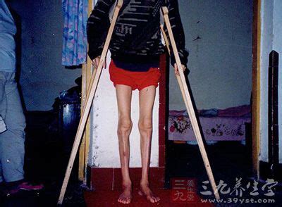 肌营养不良症状