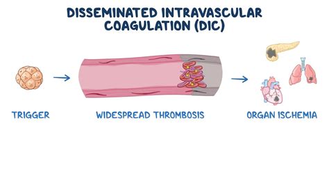 Video Disseminated Intravascular Coagulation Clinical Sciences Osmosis