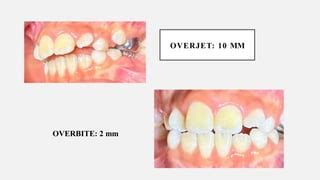 Caso Clínico De Ortopedia Dental Odontopediatría Pptx
