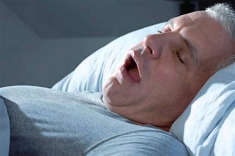 Síndrome de la apnea del sueño