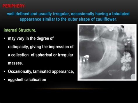 Soft Tissue Calcification Orofacial Region